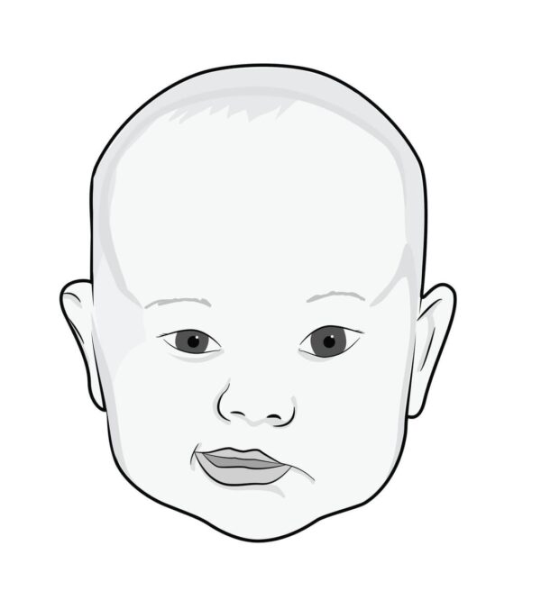 The Impact of Cranial-Facial Distortions on Childhood Development and ...